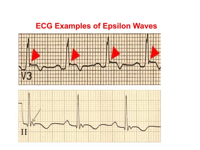 EPSILON WAVE IN ECG AND ITS INTERPRETATION | PPTX
