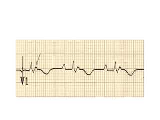 EPSILON WAVE IN ECG AND ITS INTERPRETATION | PPTX