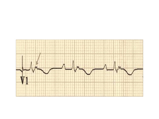 EPSILON WAVE IN ECG AND ITS INTERPRETATION | PPTX