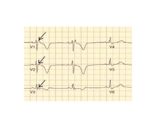 EPSILON WAVE IN ECG AND ITS INTERPRETATION | PPTX