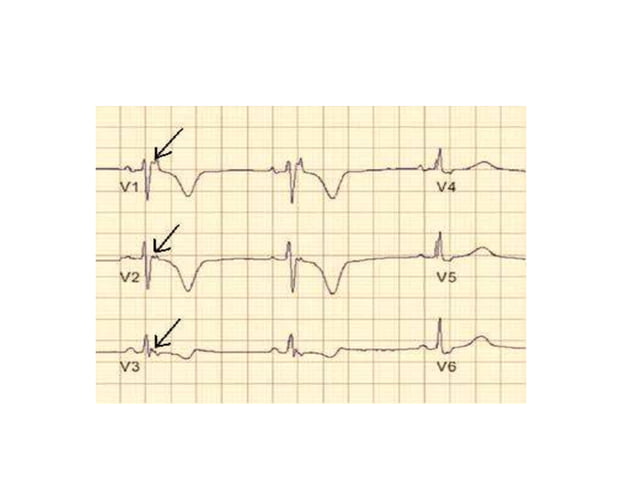 EPSILON WAVE IN ECG AND ITS INTERPRETATION | PPT EPSILON WAVE IN ECG AND ITS INTERPRETATION | PPT