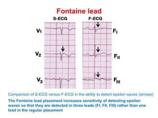 EPSILON WAVE IN ECG AND ITS INTERPRETATION | PPTX