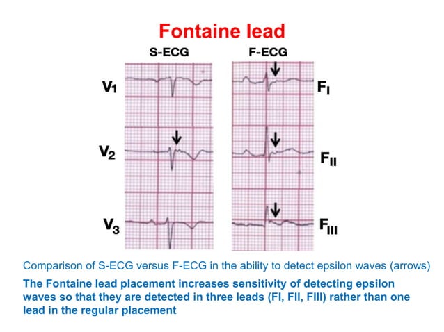 EPSILON WAVE IN ECG AND ITS INTERPRETATION | PPTX