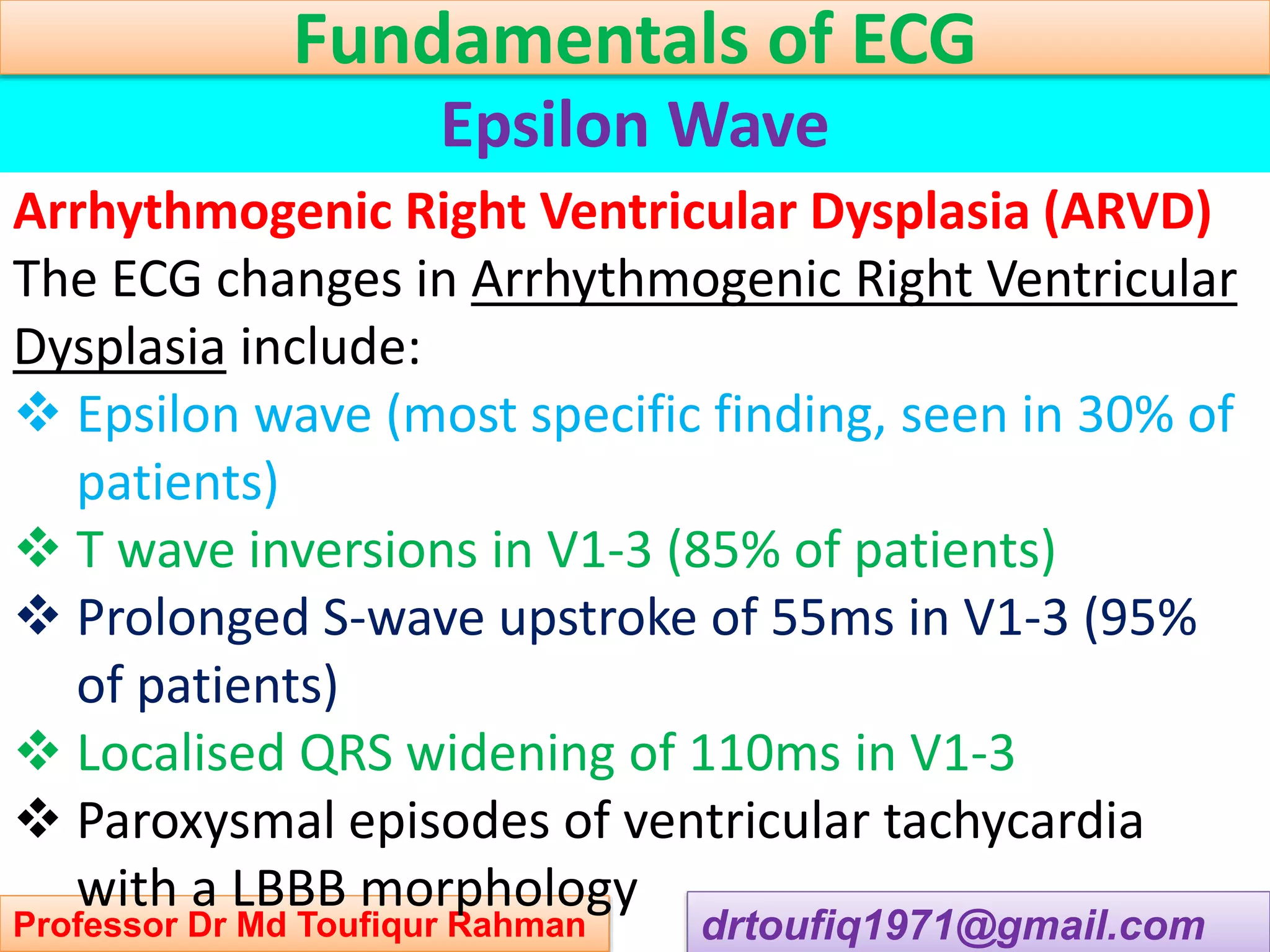 Epsilon wave in ECG | PPSX | Heart and Cardiovascular Diseases ...