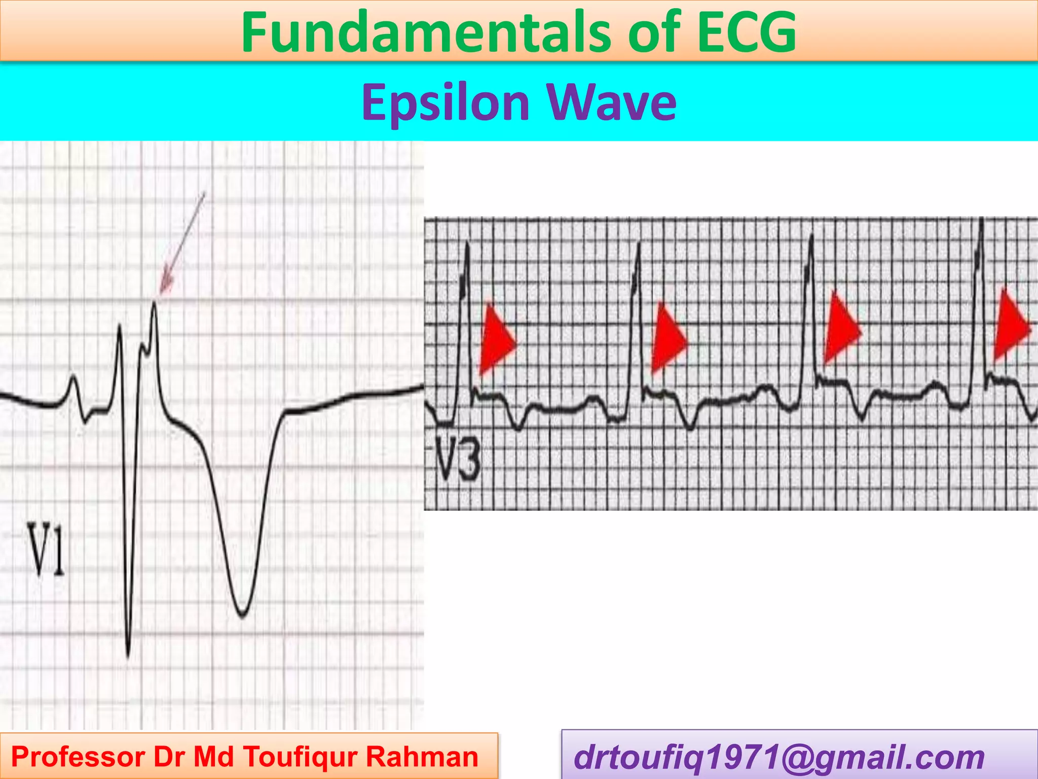 Epsilon wave in ECG | PPSX