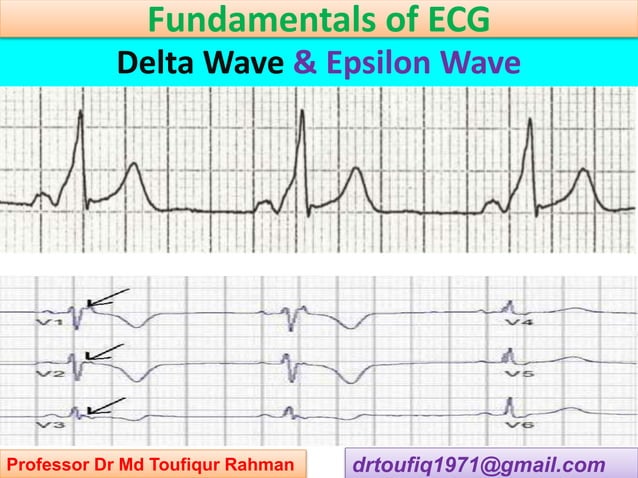 Epsilon wave in ECG | PPSX | Heart and Cardiovascular Diseases ...
