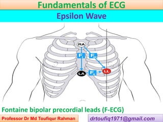 Epsilon wave in ECG | PPSX