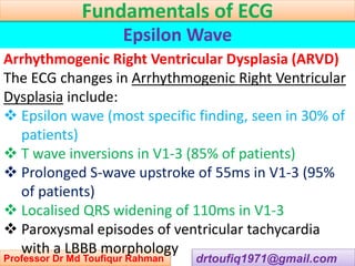 Epsilon wave in ECG | PPSX