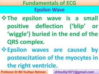 Epsilon wave in ECG | PPT