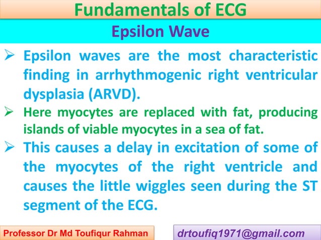 Epsilon wave in ECG | PPSX | Heart and Cardiovascular Diseases ...