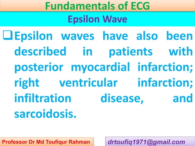 Epsilon wave in ECG | PPSX | Heart and Cardiovascular Diseases ...