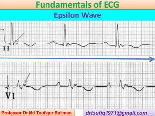 Epsilon wave in ECG | PPSX