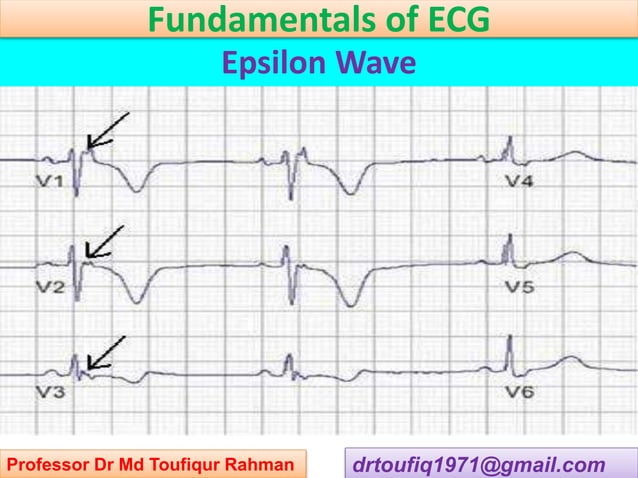 Epsilon wave in ECG | PPSX | Heart and Cardiovascular Diseases ...