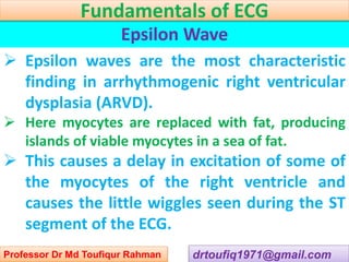 Epsilon wave in ECG | PPT