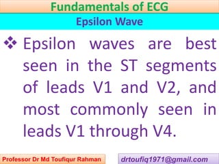 Epsilon wave in ECG