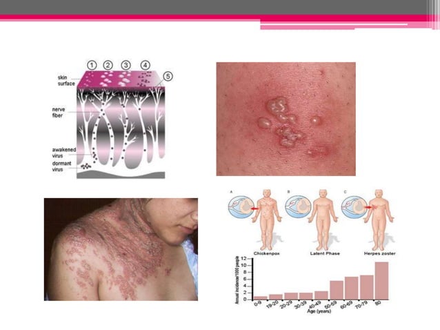 Epstein barr virus (ebv) and varicella | PPT