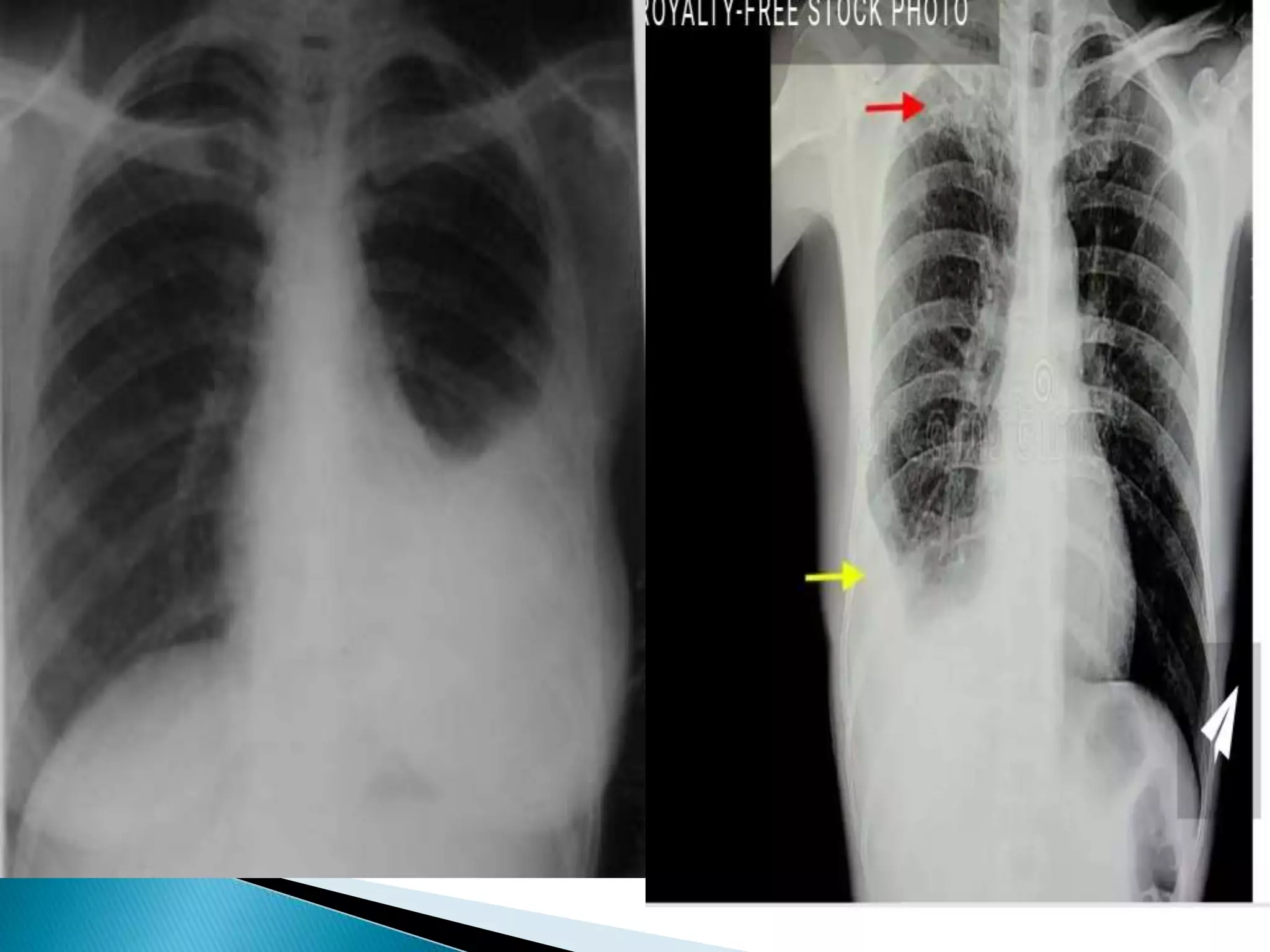 Extra pulmonary TB | PPT