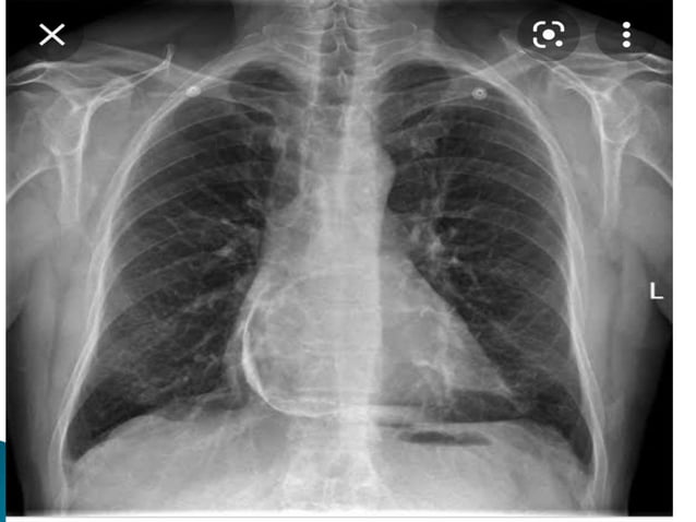 Extra pulmonary TB | PPT | Lung and Respiratory Health | Diseases and ...