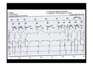 Pacemaker Mediated Tachycardia... or not? | PDF