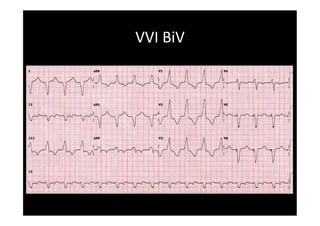 Pacemaker Mediated Tachycardia... or not? | PDF