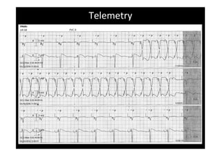 Pacemaker Mediated Tachycardia... or not? | PDF