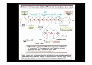 Pacemaker Mediated Tachycardia... or not? | PDF