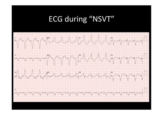 Pacemaker Mediated Tachycardia... or not? | PDF