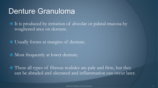 Common Benign Mucosal Swellings of Oral Cavity | PPTX