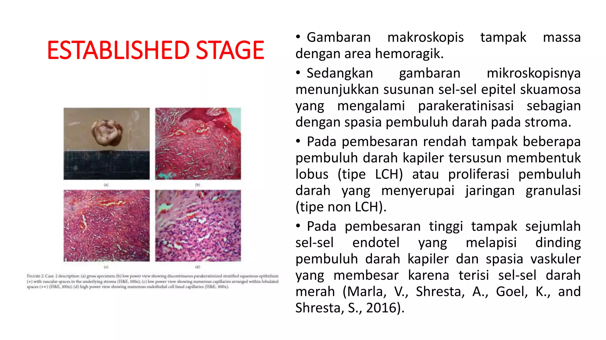 Epulis granulomatosa | PPTX