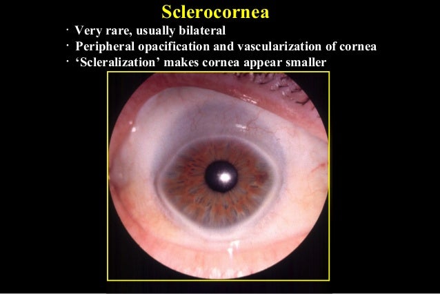 19 congen corneal anoms