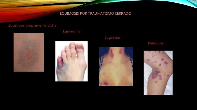 Equimosis O Hematoma