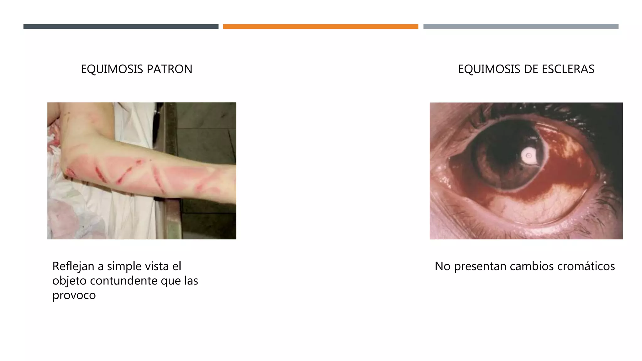 Equimosis y hematomas | PPTX