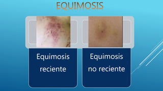 Equimosis y hematomas | PPTX