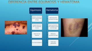 Equimosis y hematomas | PPTX