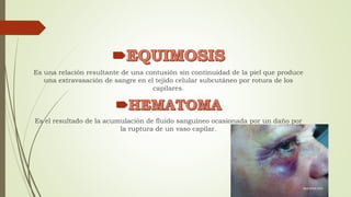 Equimosis y Hematomas | PPTX