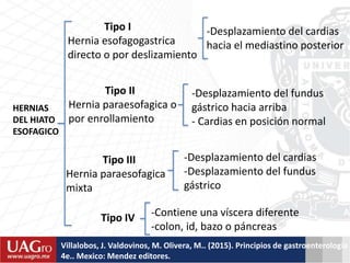 Equipo 5 hernia hiatal y diafragmatica terminada | PPTX