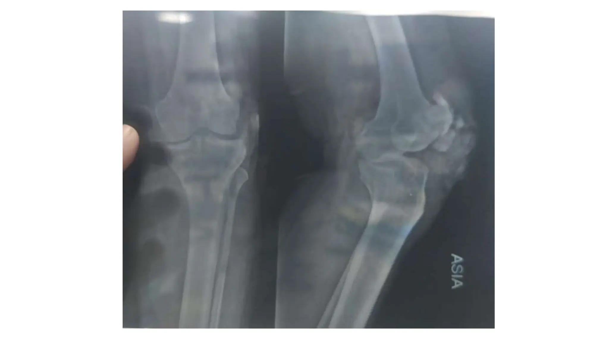 Emergency department bone fracture management | PPT