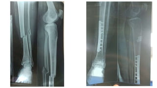 Emergency department bone fracture management | PPT