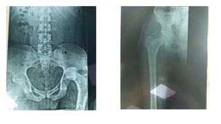 Emergency department bone fracture management | PPTX