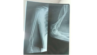 Emergency department bone fracture management | PPTX