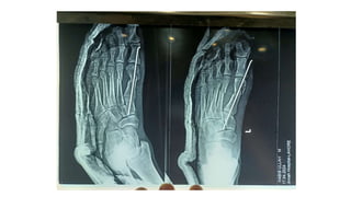 Emergency department bone fracture management | PPT