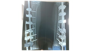 Emergency department bone fracture management | PPT