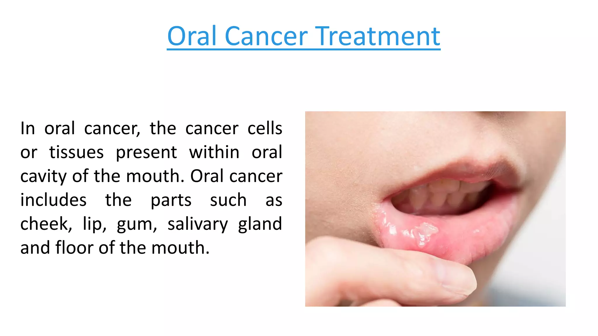Eradicate Oral Cancer with Mouth Cancer Treatment | PPTX