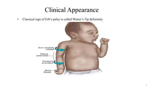 Erb's palsy.pptx
