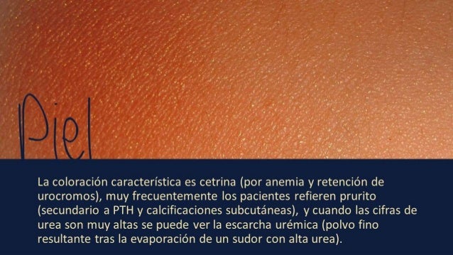 Enfermedad Renal Crónica