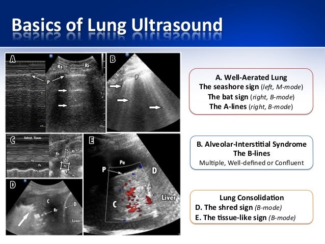 Lung Ultrasound, an essential tool in Chest Physiotherapy