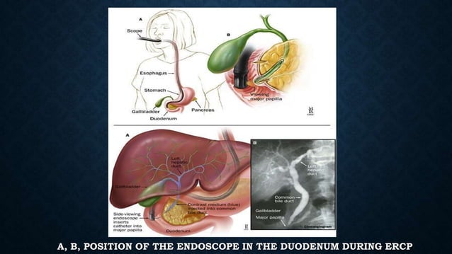 Ercp | PPTX | Digestive Disorders | Diseases and Conditions