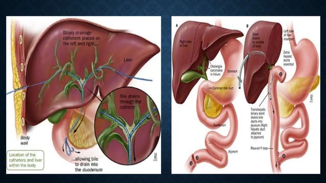 Ercp | PPTX | Digestive Disorders | Diseases and Conditions