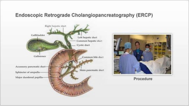 Ercp | PPTX | Digestive Disorders | Diseases and Conditions