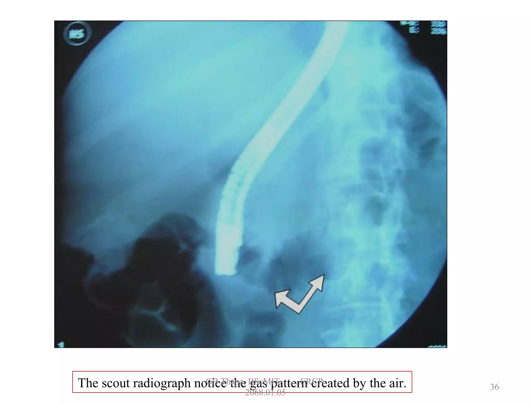 ERCP PROCEDURE | PPT